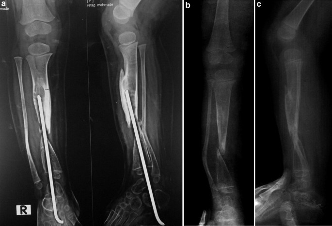 Congenital Pseudarthrosis Tibia (El-Rosasy – Paley Type 2) | SpringerLink
