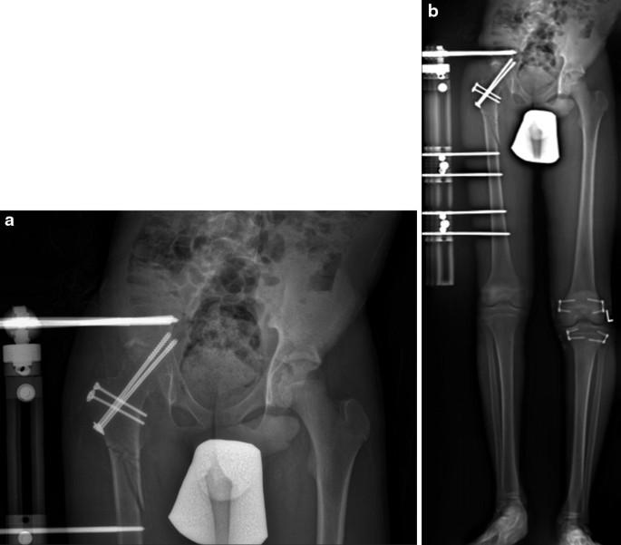 Hip Fusion with an External Fixator | SpringerLink