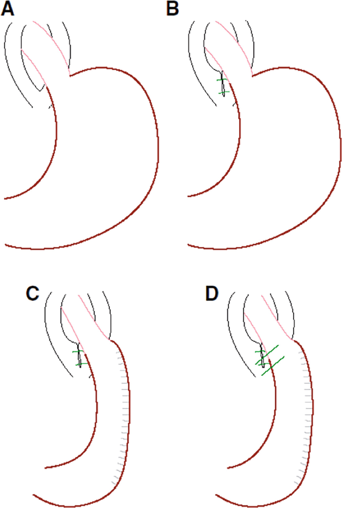 Modified Hill Procedure | Springer Nature Link