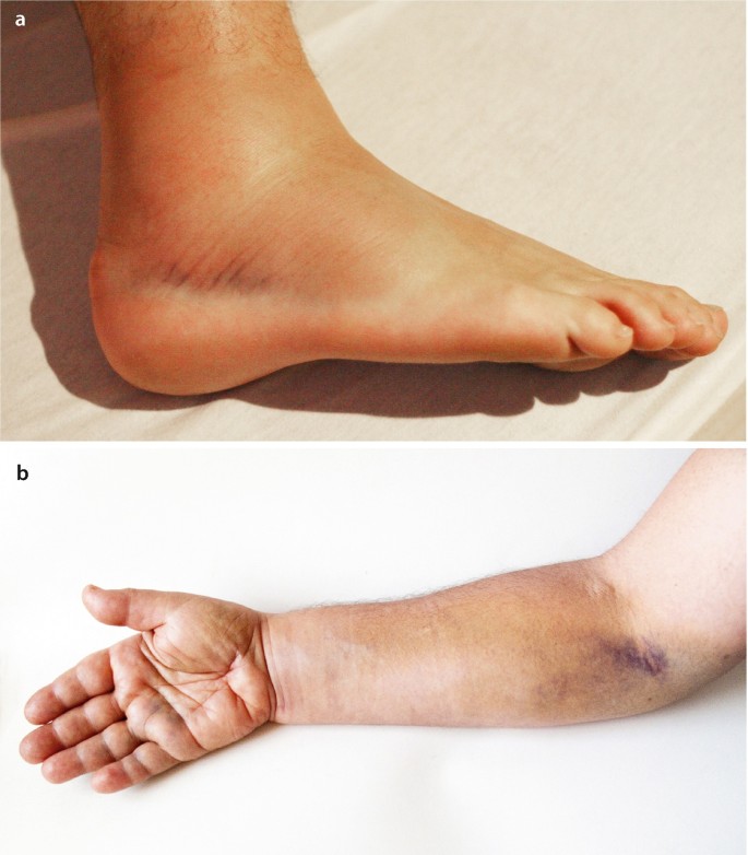 Trauma and Lymphoedema. The Special Case of Secondary Lymphoedema on ...