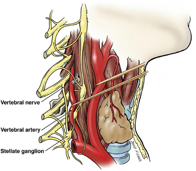 Vertebral Artery | SpringerLink