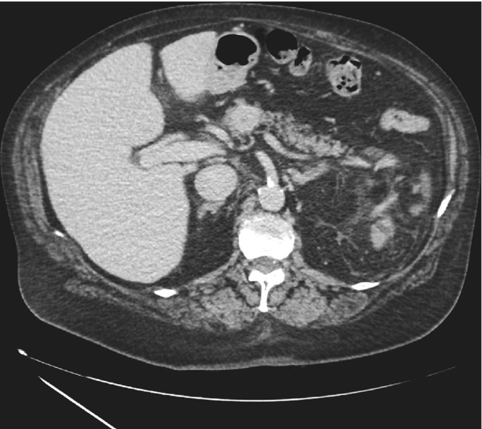 Secondary Malignant Neoplasms | SpringerLink