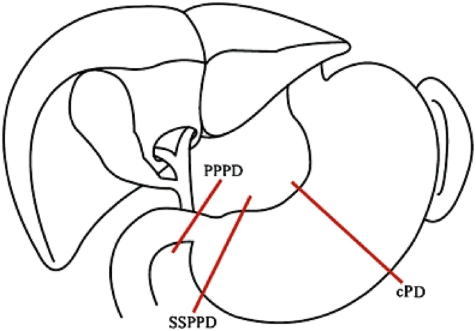 Delayed Gastric Emptying | SpringerLink