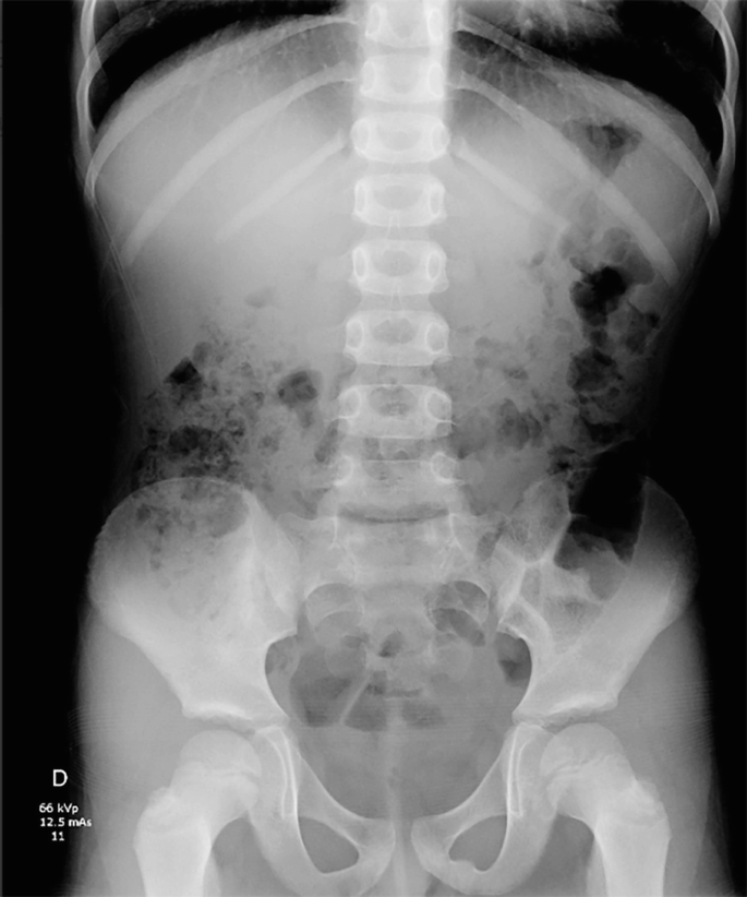Acute Abdomen Radiographic Evaluation | Springer Nature Link (formerly ...
