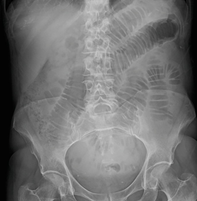 Obstructive Acute Abdomen | Springer Nature Link