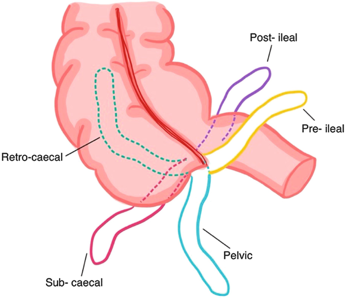 Acute Appendicitis | Springer Nature Link (formerly SpringerLink)