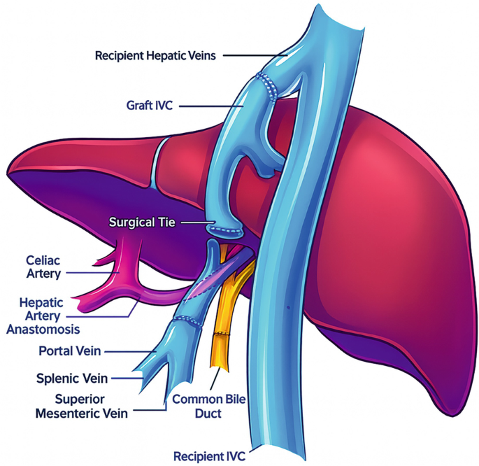 Liver Transplant | SpringerLink