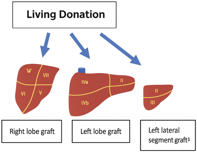 Living Donor Liver Transplantation | Springer Nature Link (formerly ...