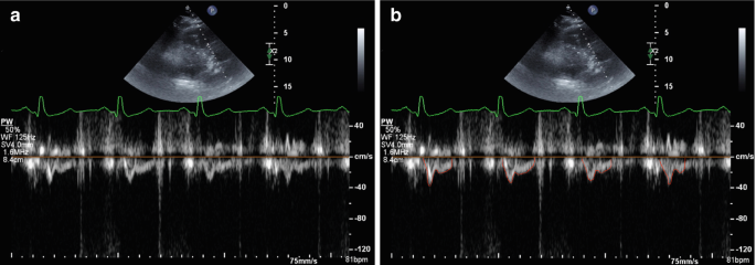 Pulmonary Embolism and Acute Cor Pulmonale | Springer Nature Link ...