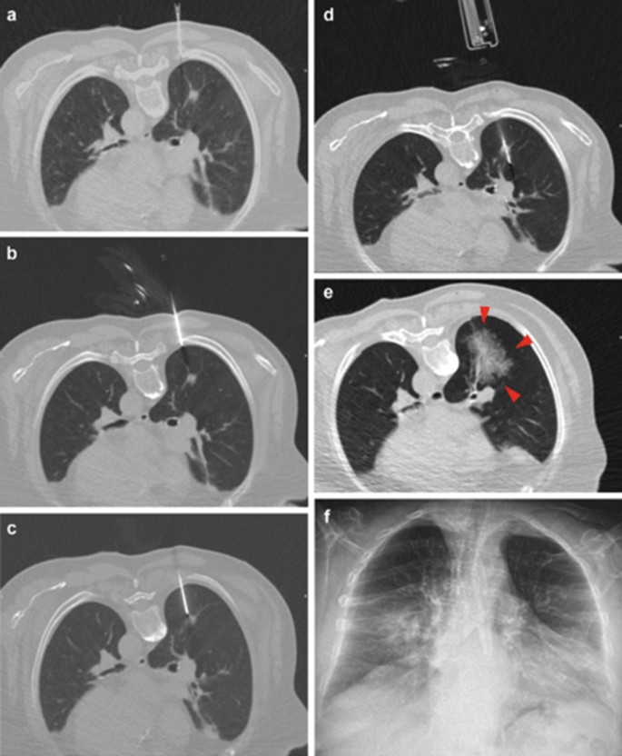 Transthoracic Needle Biopsy | Springer Nature Link