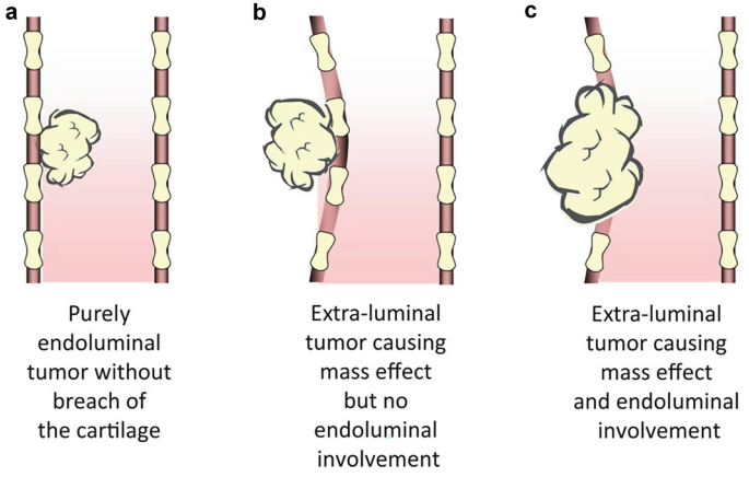 Malignant Central Airway Obstruction | Springer Nature Link
