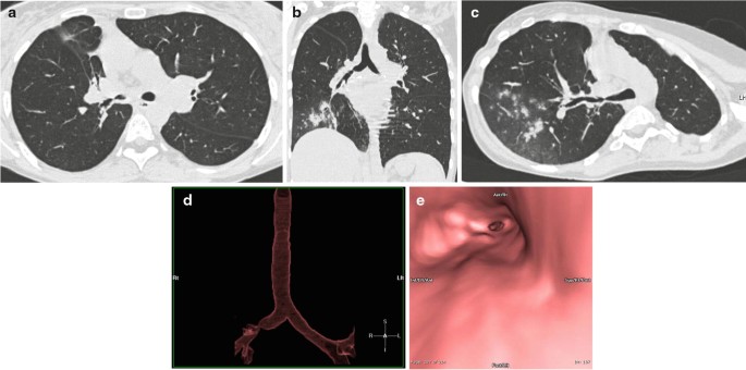 Innovations in Airway Visualization for the Interventional ...