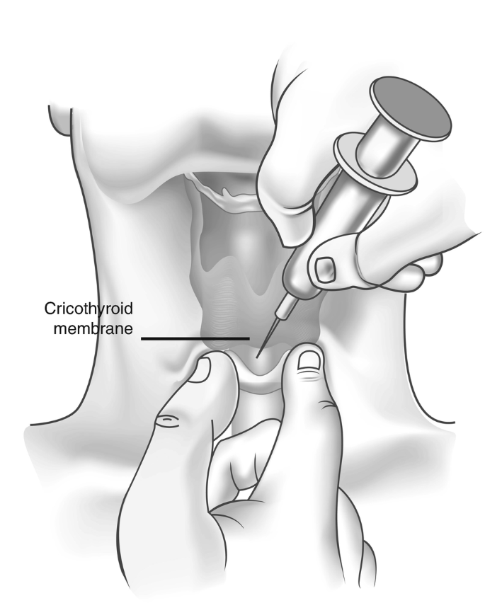 Cricothyroidotomy | SpringerLink