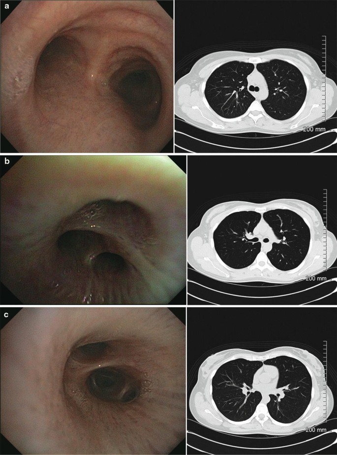 Airway Anatomy | SpringerLink