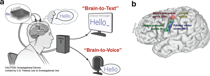 A Rapidly Deployable High-Performance Speech Neuroprosthesis | SpringerLink