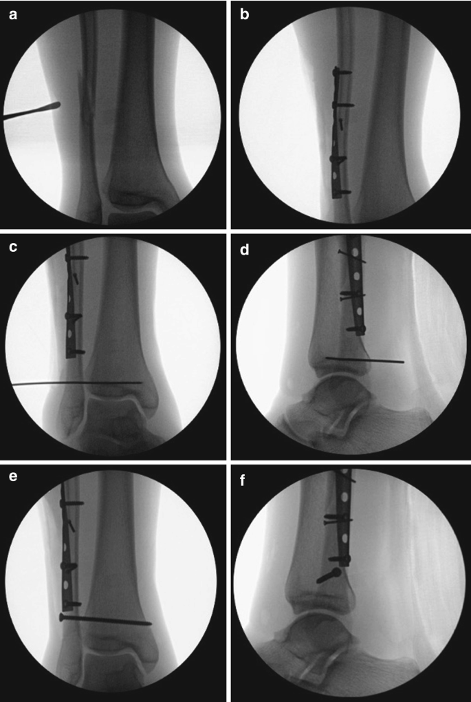 Approaches to the Management of Syndesmotic Injuries | SpringerLink