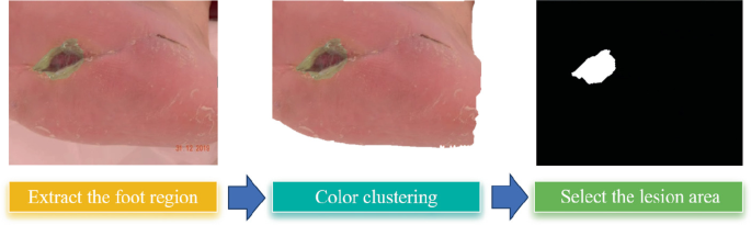 CDe: Focus on the Color Differences in Diabetic Foot Images | Springer ...