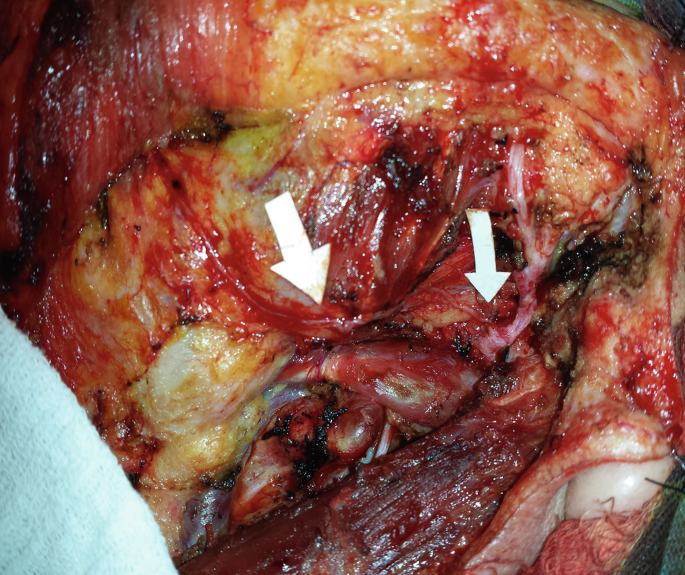 Fascicular Turnover Flap of the Facial Nerve | Springer Nature Link ...