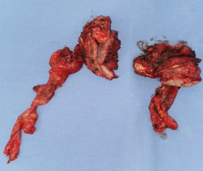 Fascia Latae Perforator Flap | SpringerLink