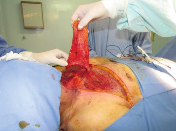 Internal Mammary Artery Perforator (IMAP) Flap | SpringerLink