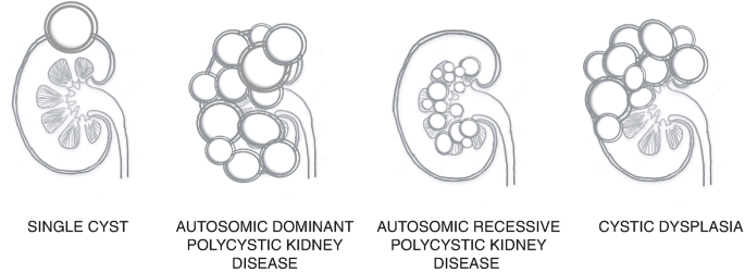 Hypertension in Cystic and Polycystic Kidney Disease | SpringerLink