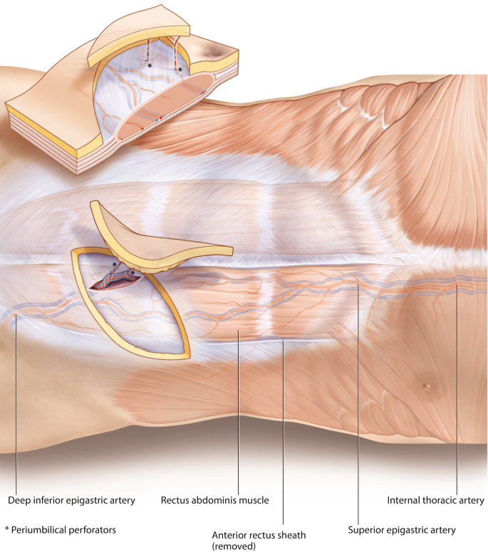 Deep Inferior Epigastric Artery Perforator Flap | Springer Nature Link