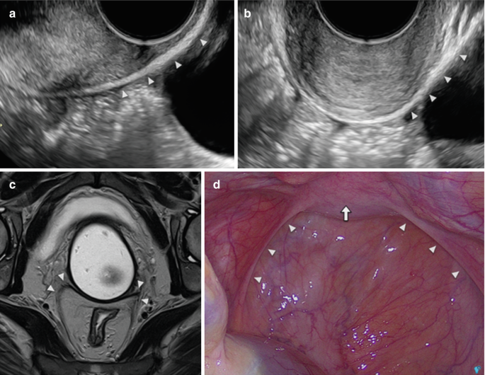 Mediocentral Compartment: Torus Uterinum and Proximal Uterosacral ...