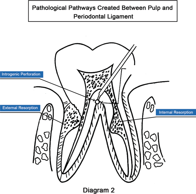 Endodontic–Periodontal Relationship | SpringerLink