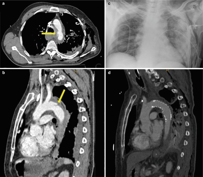 Imaging of Chest Trauma | SpringerLink