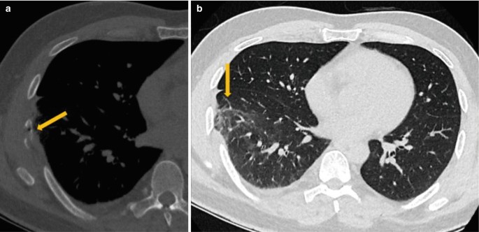 Imaging of Chest Trauma | SpringerLink
