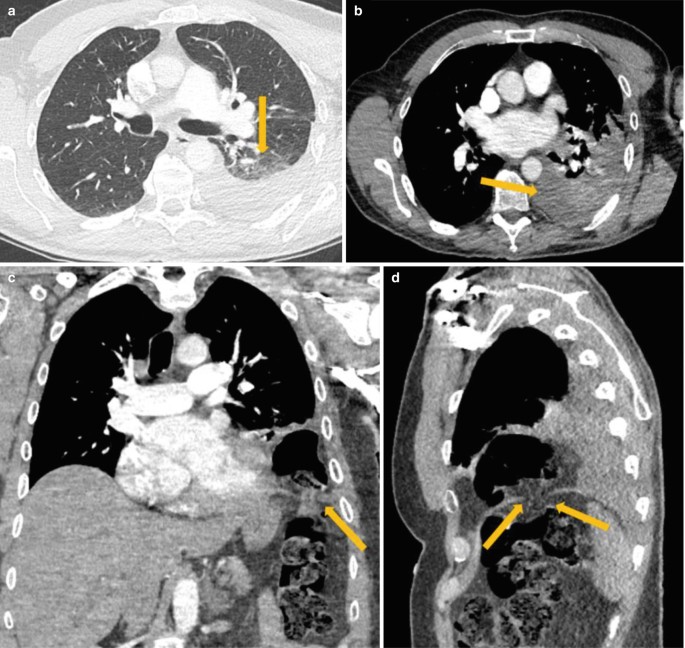 Imaging of Chest Trauma | SpringerLink