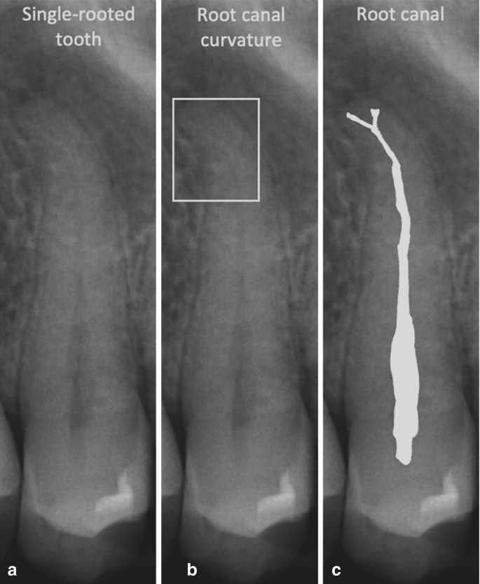 Artificial Intelligence in Endodontics | SpringerLink