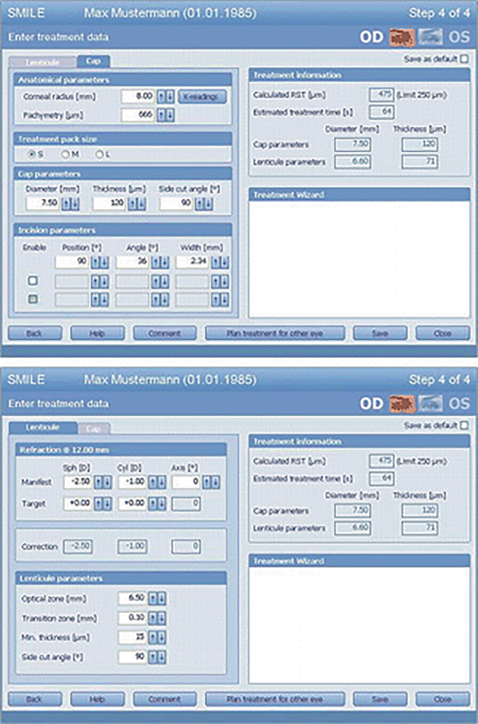 SMILE: Small Incision Lenticule Extraction—A Basic Guideline | Springer ...