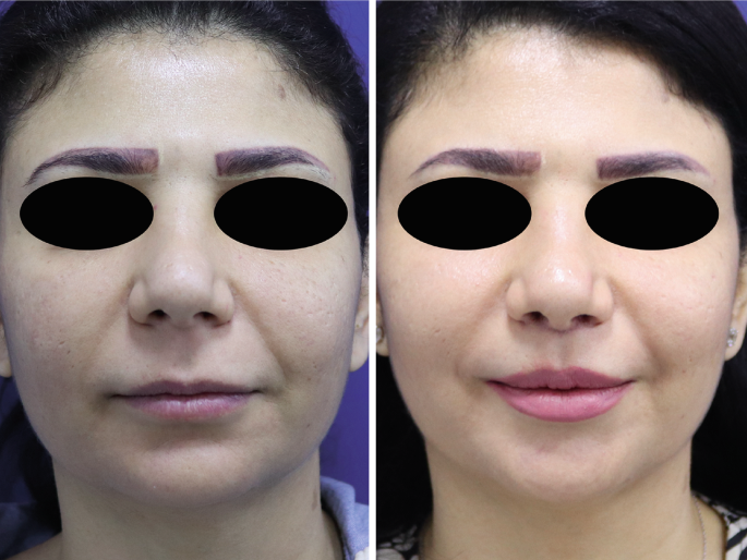 Lip Lift Surgery | Springer Nature Link (formerly SpringerLink)