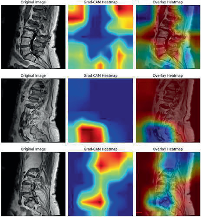 RSNA 2024: Multi-view Quantum Deep Learning Model for Degenerative Lumbar Spine Classification ...