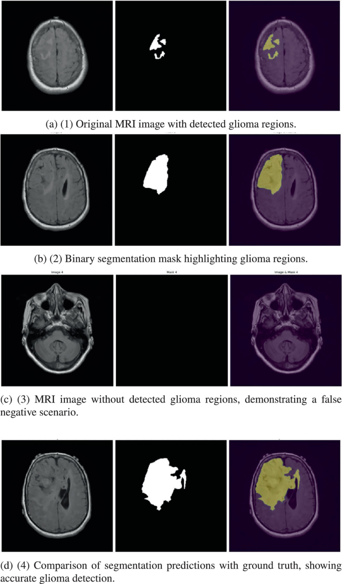 Glioma Segmentation in T1-Weighted MRI Images Using Deep Learning | SpringerLink