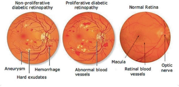 Classification of Retinal Fundus Images for Diabetic Retinopathy Using ...