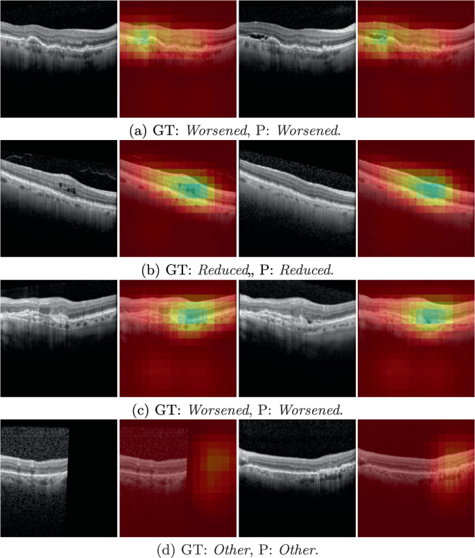 Automatic Detection and Prediction of nAMD Activity Change in Retinal ...