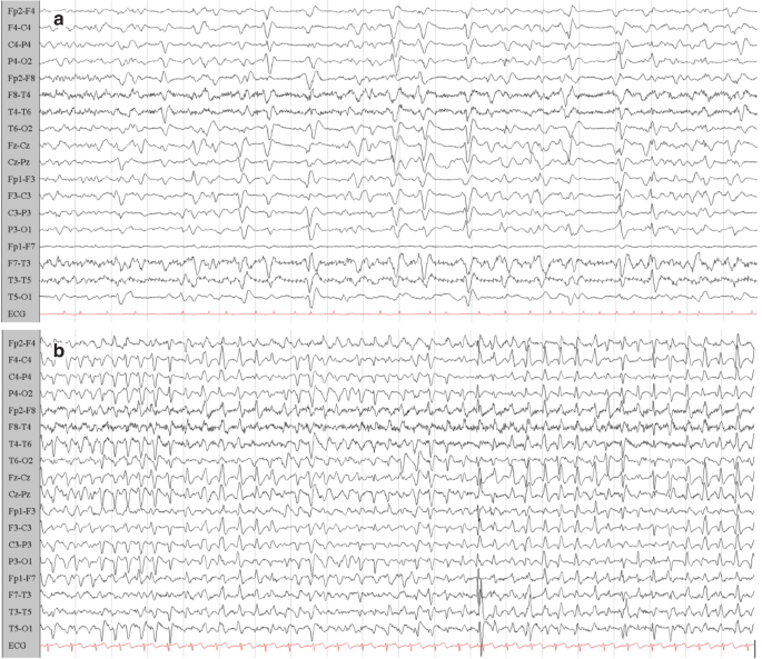 EEG in Emergencies | SpringerLink