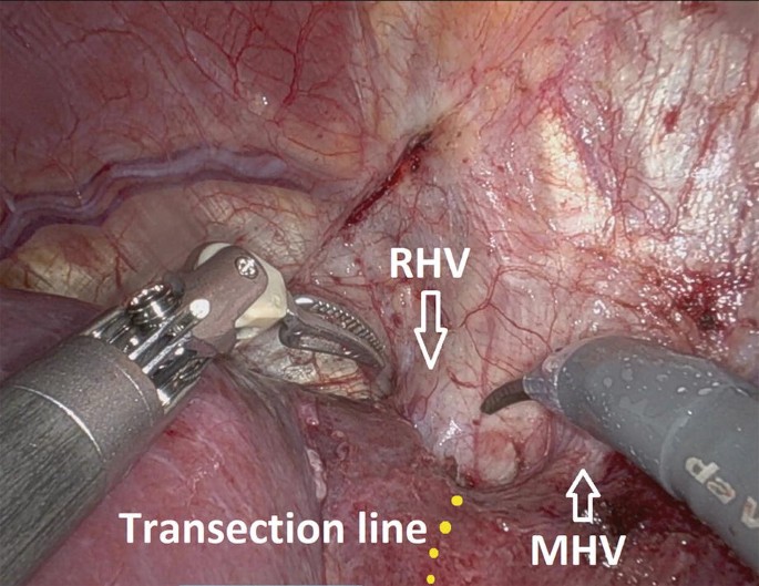 Liver Resection and Biliary Reconstruction | SpringerLink