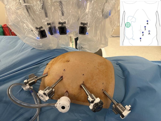 Right Hemicolectomy | SpringerLink