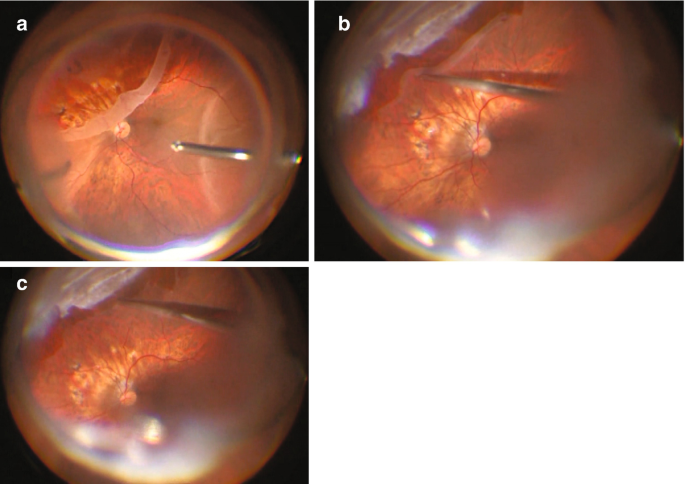 Retinal Detachments Associated with Giant Retinal Tear | Springer ...