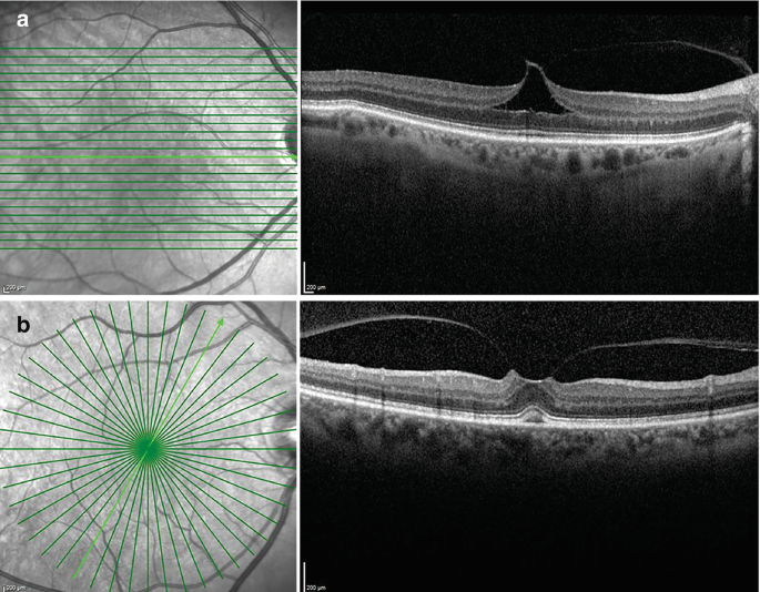 Vitreomacular Traction Syndrome | Springer Nature Link (formerly ...