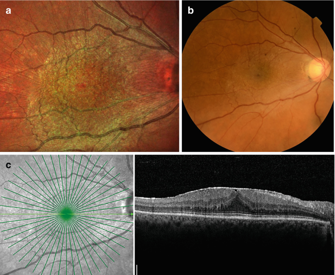 Epiretinal Membrane | Springer Nature Link