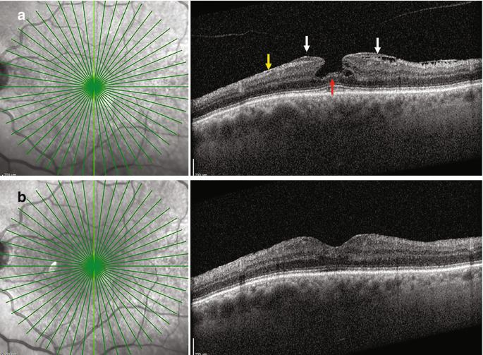 Lamellar Macular Hole | Springer Nature Link (formerly SpringerLink)