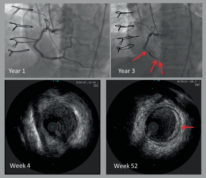 Cardiac Allograft Vasculopathy | SpringerLink