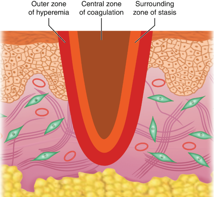 Mechanobiology of Scarring | Springer Nature Link (formerly SpringerLink)