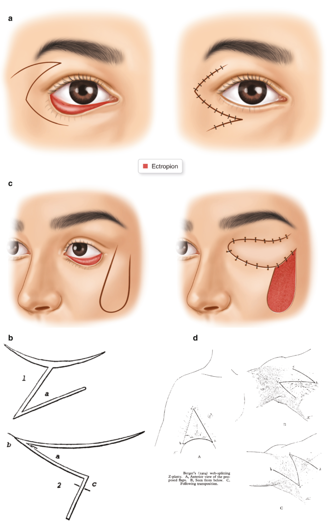 Essential Aspects of Transposition Flaps, Particularly Z-Plasties ...