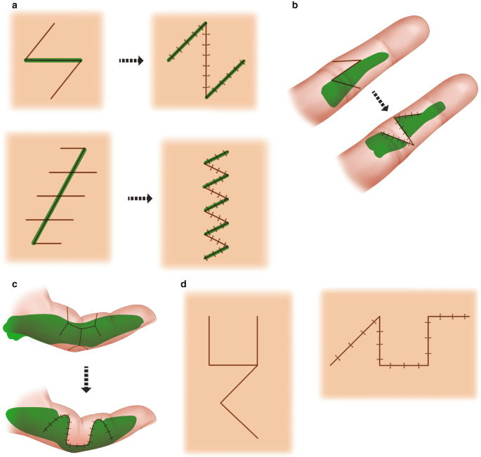 Essential Aspects of Transposition Flaps, Particularly Z-Plasties ...