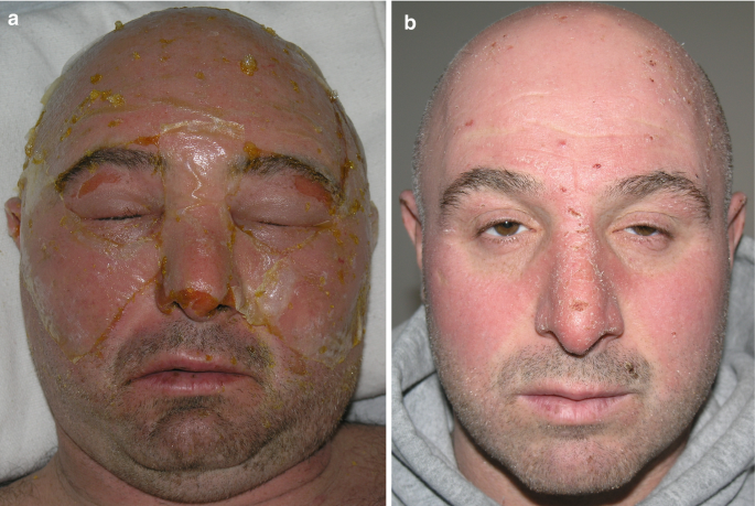 Facial Reconstruction | Springer Nature Link